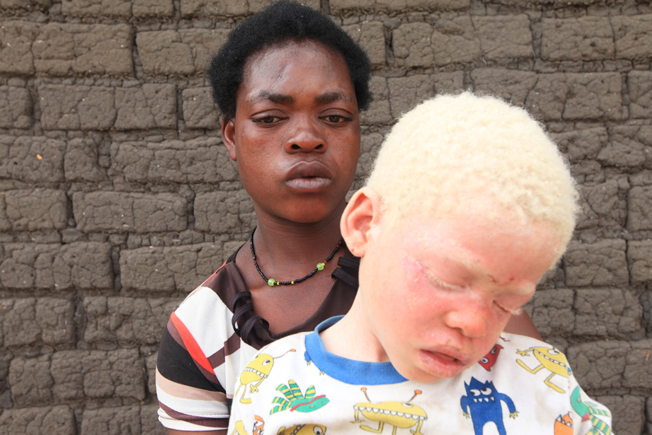 Edna Cedrick, 26, holds her surviving albino son after his twin brother ...