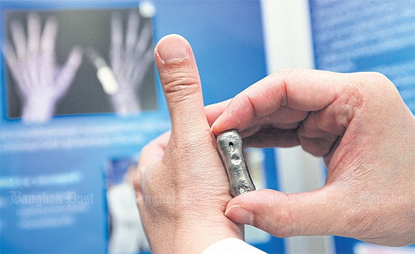 Bangkok Post - Thumb surgery a success