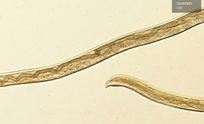 Woman Becomes First Human With Eye Worms Youtube