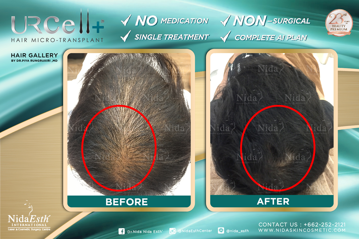 Bangkok Post - New! Stem cells hair transplant: No sexual dysfuntion ...