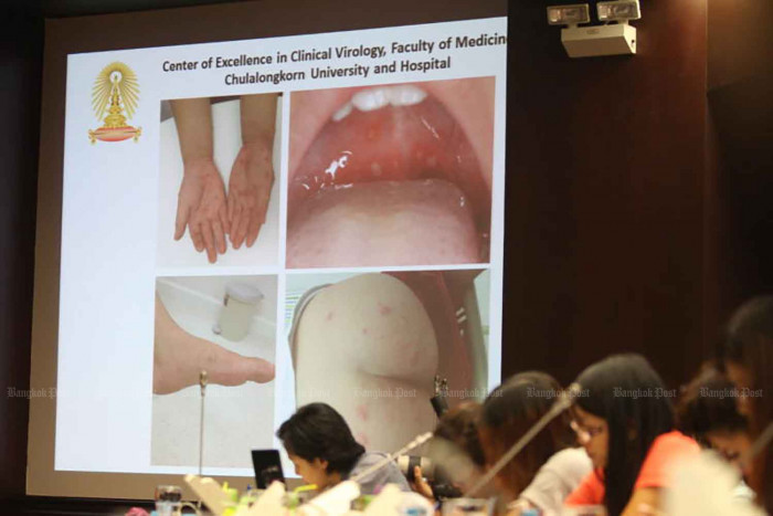 Bangkok Post - Govt confirms hand, foot and mouth disease outbreak